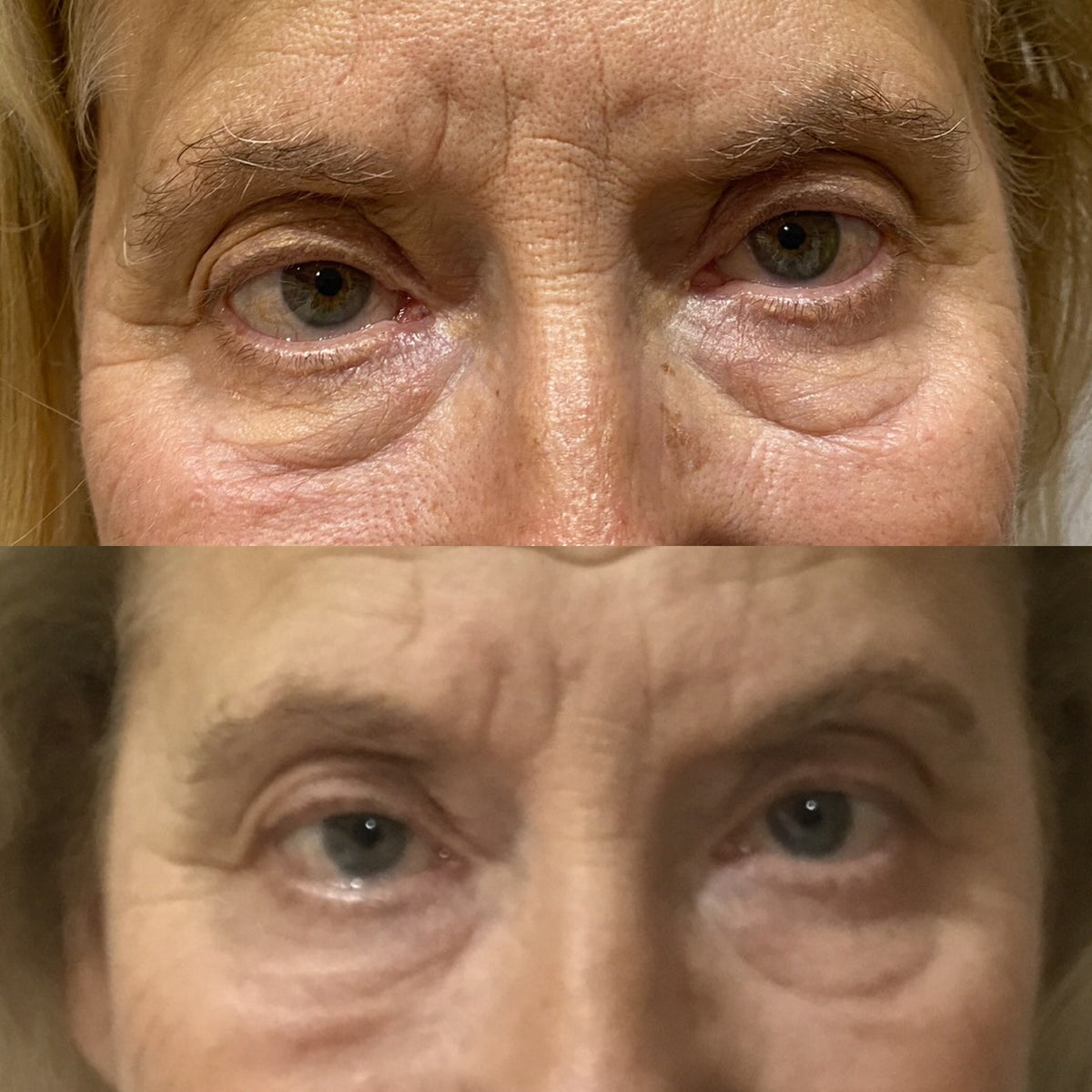 Morpheus 8 Face and Body - RF Microneedling Skin Tightening Treatment ...
