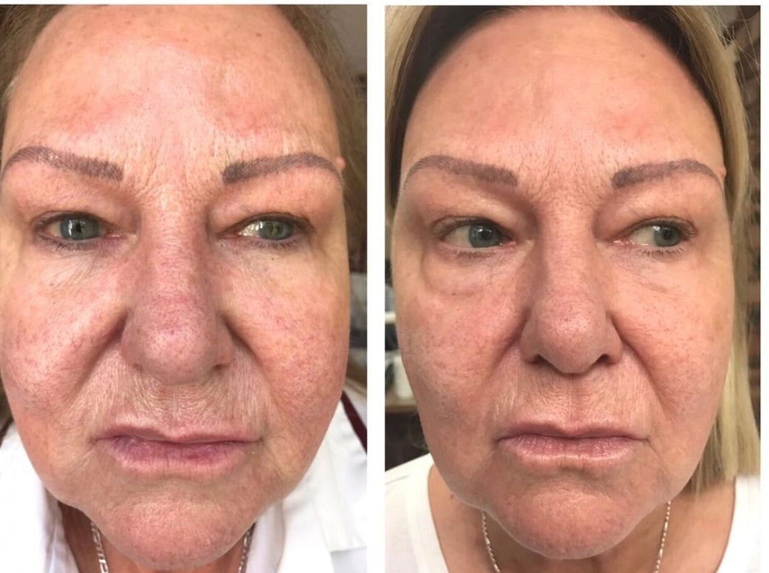 Platelet Rich Plasma Therapy for Face Rejuvenation and Hair Loss (PRP ...